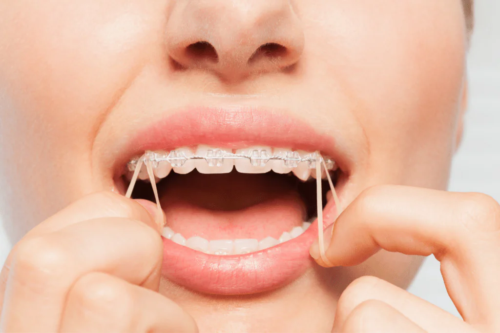 Understanding Types of Braces and Cost | Pura Vida Orthodontics